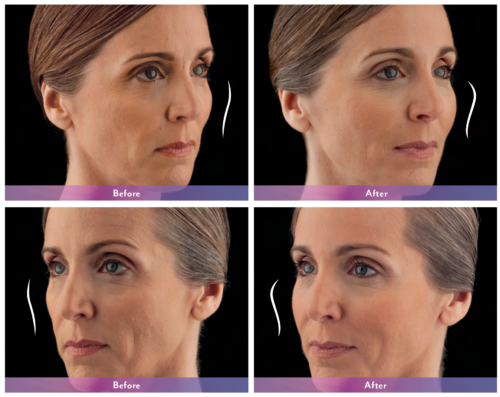 Juvederm Voluma Before and After – Forever Flawless